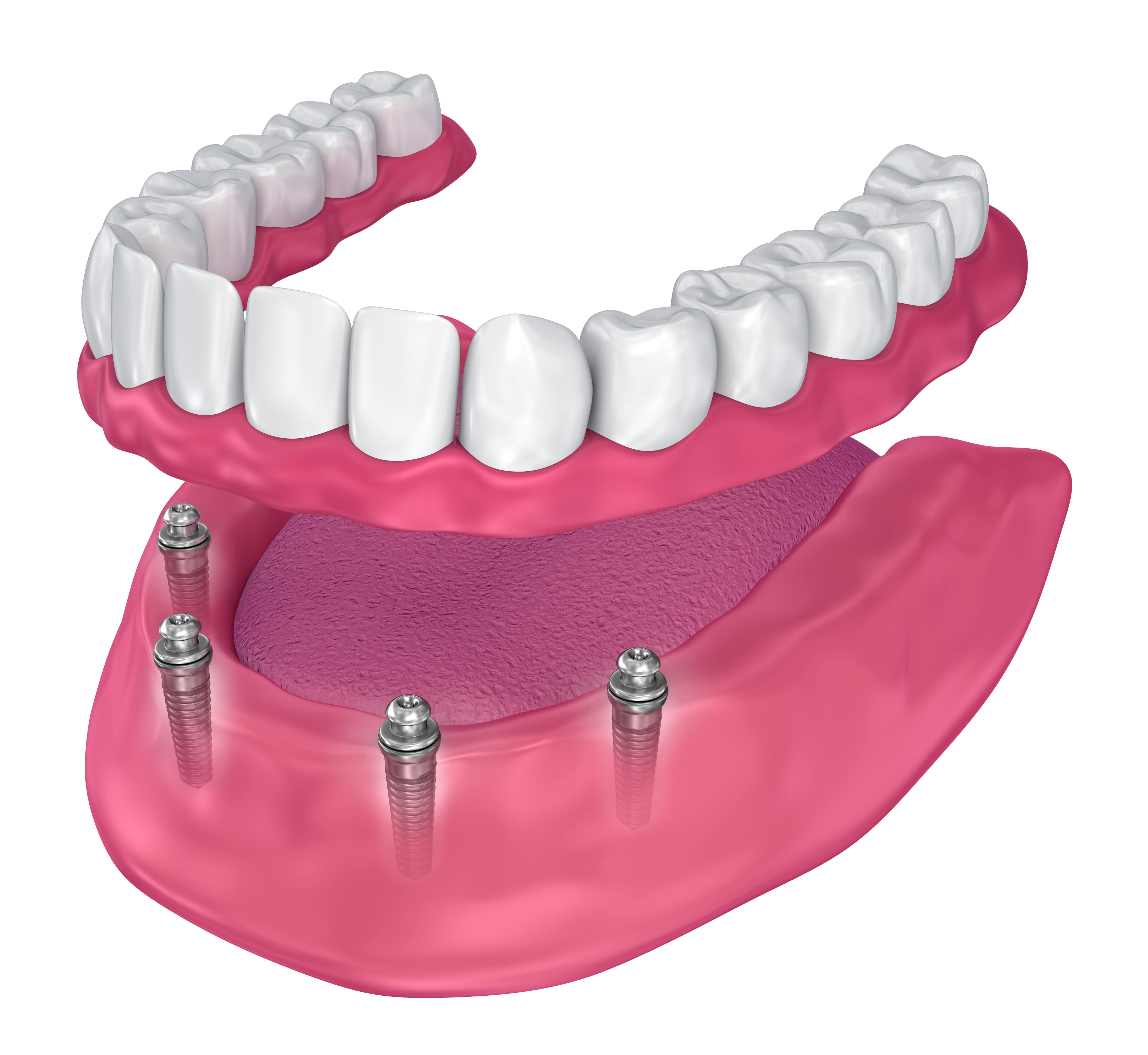 Fixed Full Dentures Treatment Bangalore Bluetooth Dental Clinic